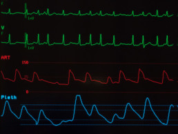 What Causes AFib (and How Can You Avoid It)? | The Emergency Center