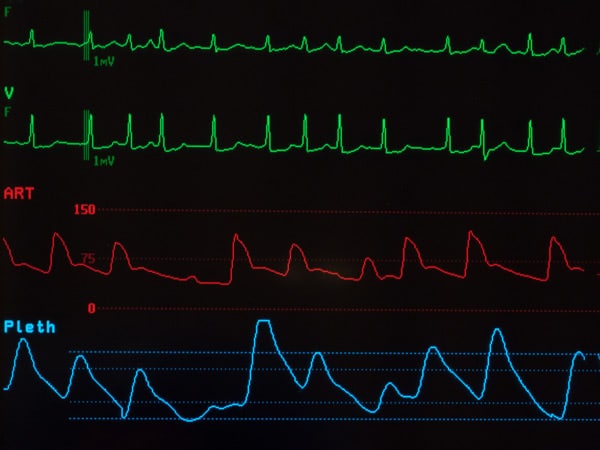 What Causes AFib (and How Can You Avoid It)? | The Emergency Center